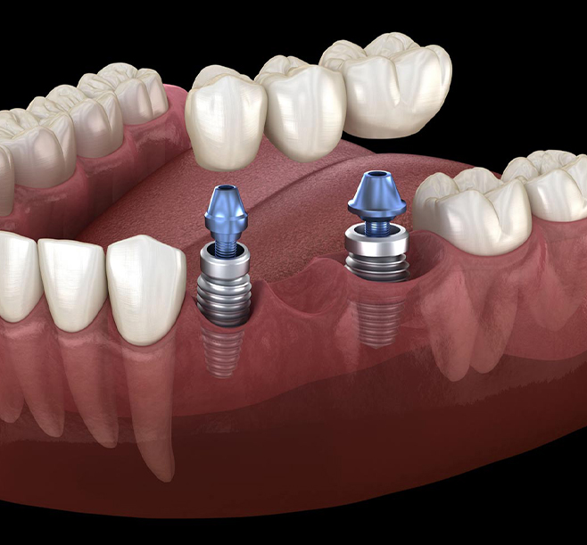 Single Tooth Implants & Bridges O'Fallon MO - Twin Oaks Family Dental