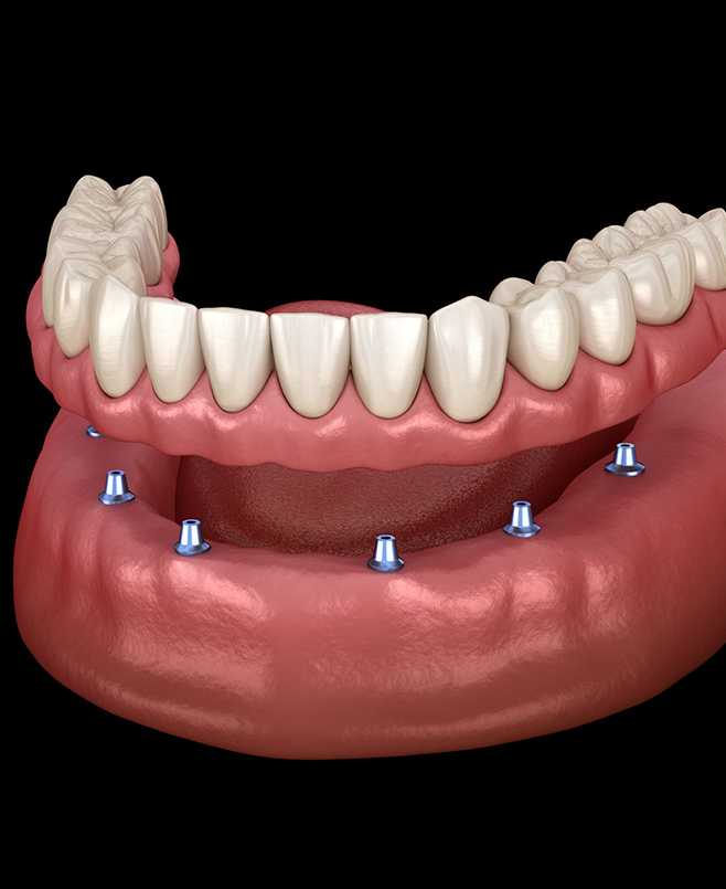 Snap-In Implant Dentures O'Fallon MO | Twin Oaks Family Dental