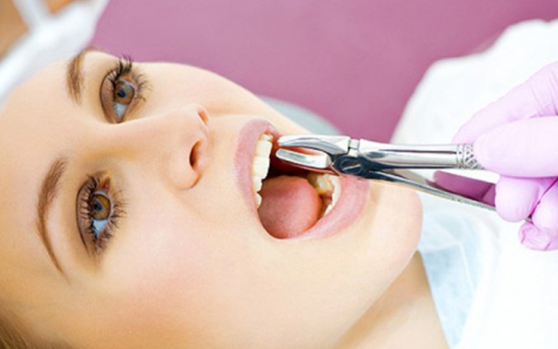 When Is Tooth Extraction Necessary? Signs To Look For